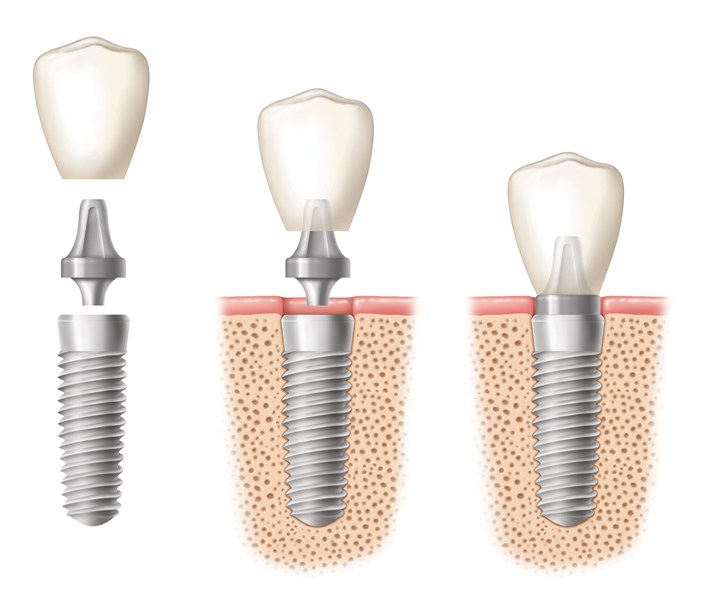 Tooth Replacement for Hockey Players - Susan M. Dennis, D.D.S